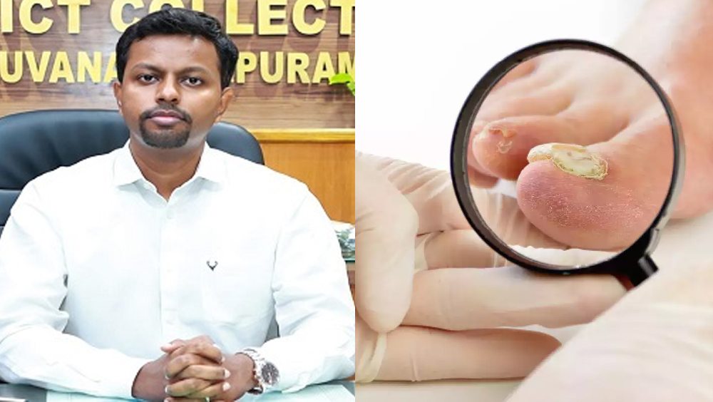 കുഴിനഖ ചികിത്സയ്ക്കായി സർക്കാർ ഡോക്ടറെ വീട്ടിലേക്ക് വിളിച്ചു വരുത്തി ...